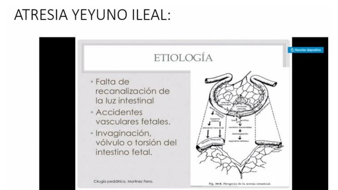 Atresia Yeyuno Ileal | Dra. Lulú | uDocz