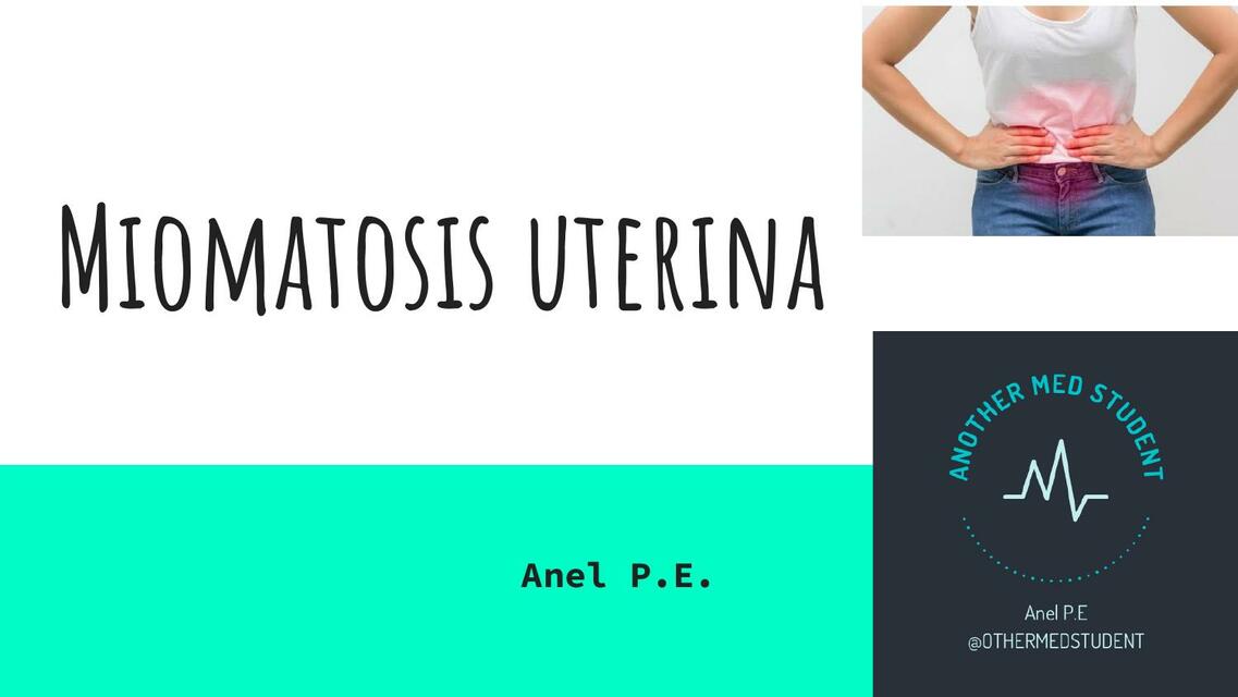 Miomatosis uterina | Anel P.E. | uDocz