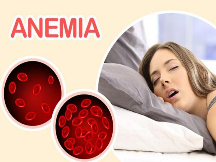 Anemia | guilian funes | uDocz