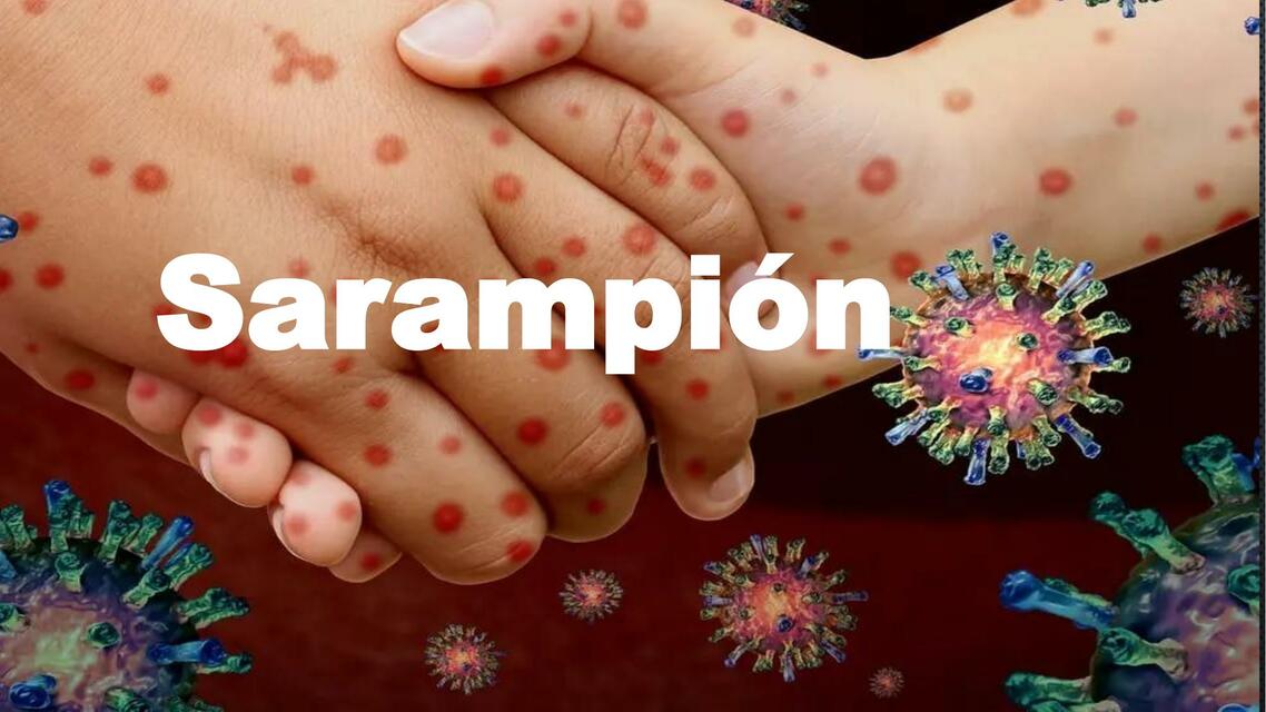 Sarampión | Nelson Suarez | uDocz