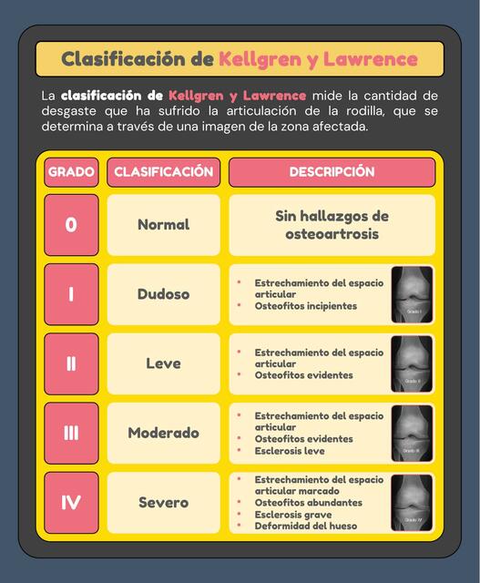 Clasificación de Kellgren y Lawrence osteoartrosis | Javier Rios | uDocz