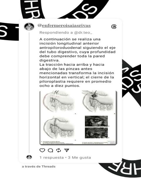 Piloroplastia | Enfermero Isaias Rivas | uDocz