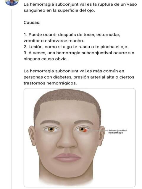 CAUSA DE LA HEMORRAGIA CONJUNTIVAL | Enfermero Isaias Rivas | uDocz