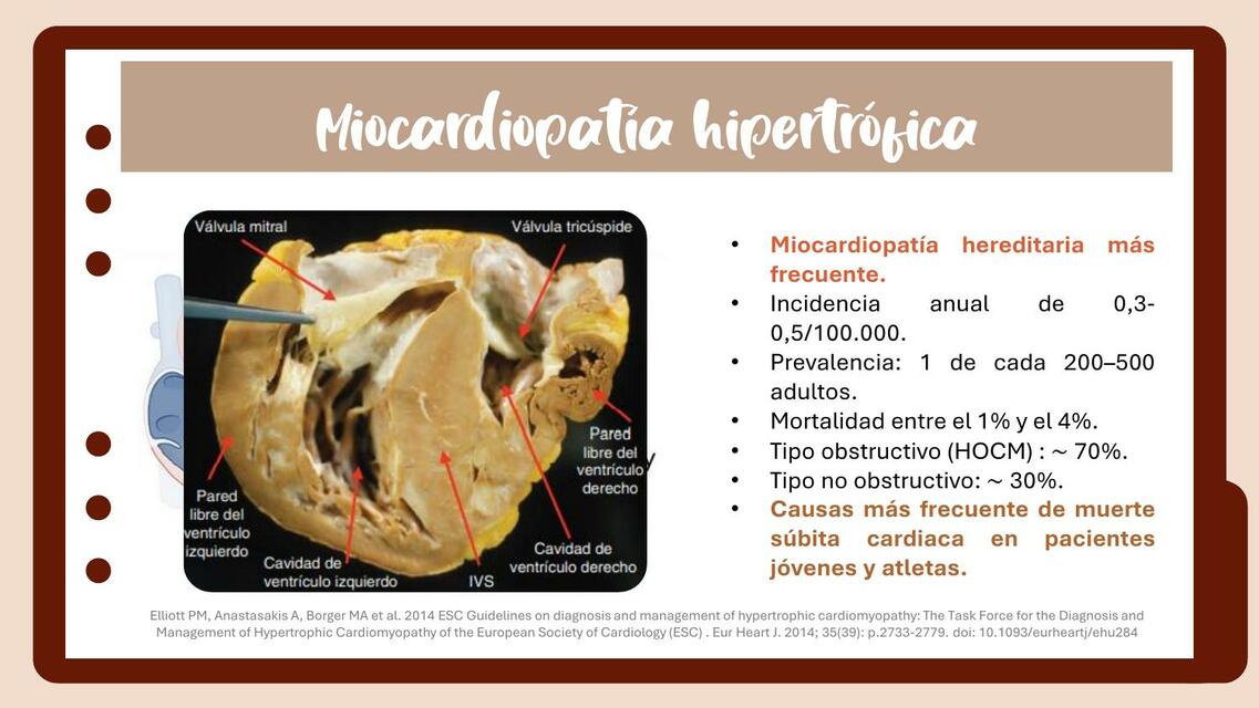 Miocardiopatía hipertrófica | Nelly_notes.med | uDocz