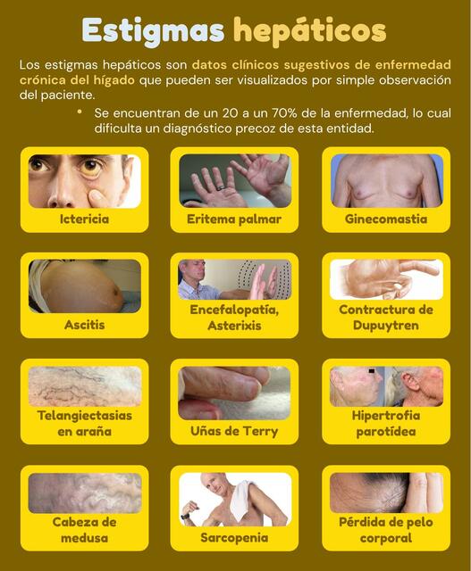 Estigmas hepáticos | Javier Rios | uDocz