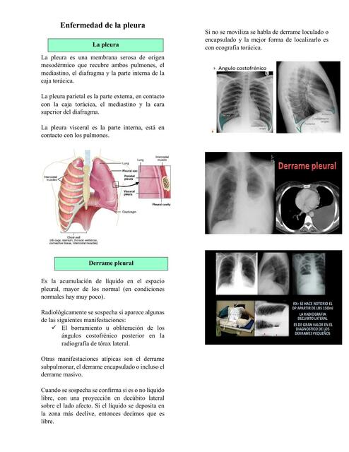 Enfermedad de la Pleura | TRIX-MED | uDocz