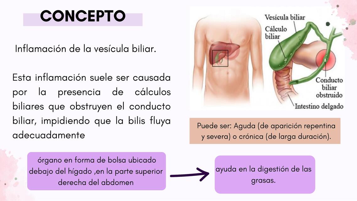 Colecistitis | Desiree Azotea | uDocz