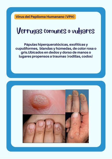 Virus del Papiloma Humano | Ana Fernanda Zhindon Macas | uDocz