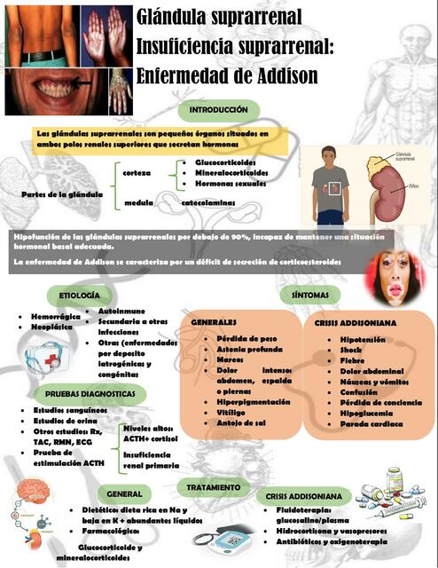 Glándula Suprarrenal. Insuficiencia Suprarrenal: Enfermedad de Addison | Gary Alvaro | uDocz