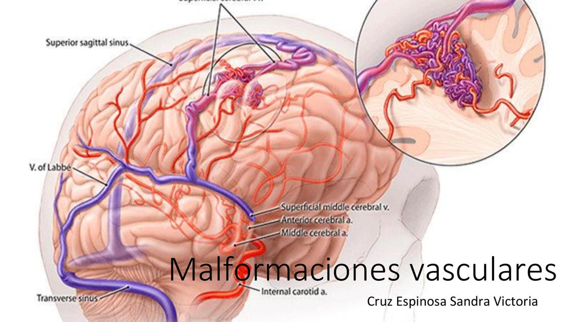 Flashcards de Malformaciones vasculares | Por sandra cruz | uDocz