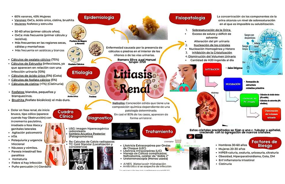 Litiasis Renal | uDocz