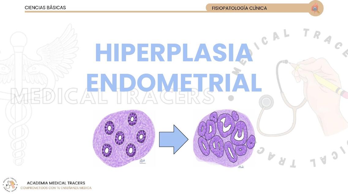 Hiperplasia endometrial | ABIGAIL ORE | uDocz