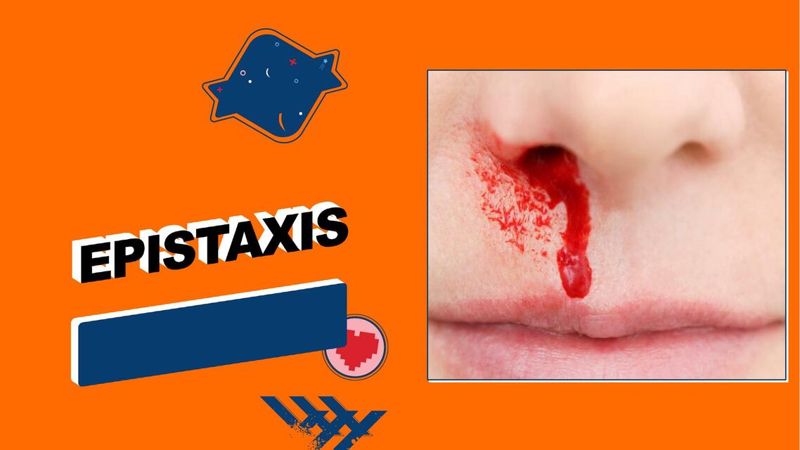 Epistaxis | Daniela Mendoza C | uDocz