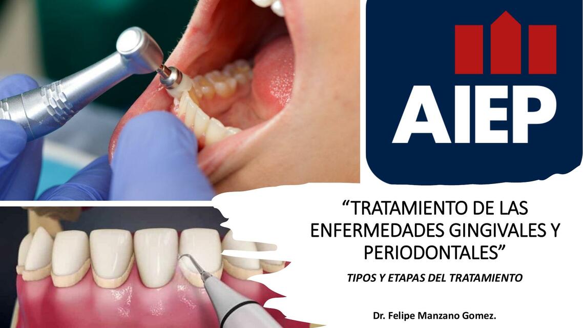 Tratamiento de las enfermedades gingivales y periodontales | Felipe ...