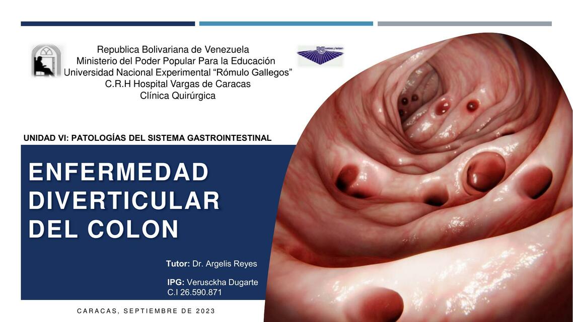Enfermedad diverticular del colon | Veronica Guanchez | uDocz