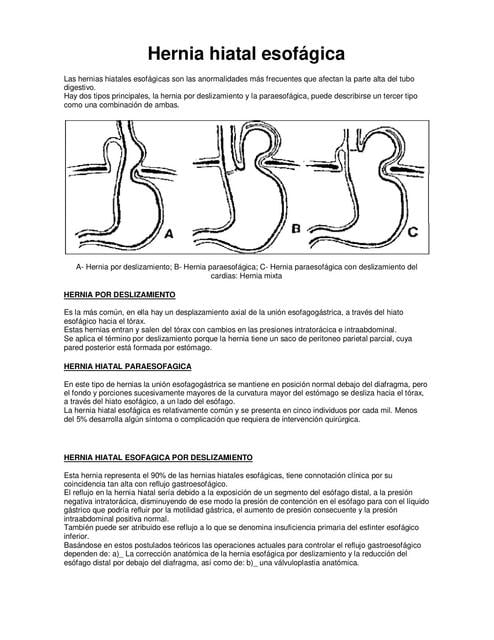 Hernia hiatal esofágica | Juan Jose Valladares Sanchez | uDocz