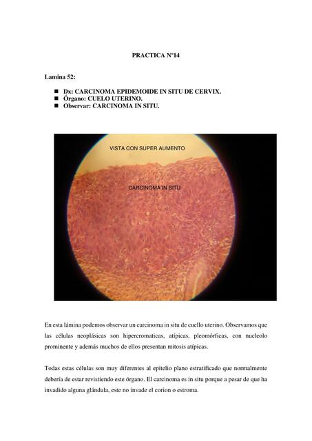 Carcinoma epidermoide in situ de cérvix | CIENCIAS DE LA SALUD | uDocz