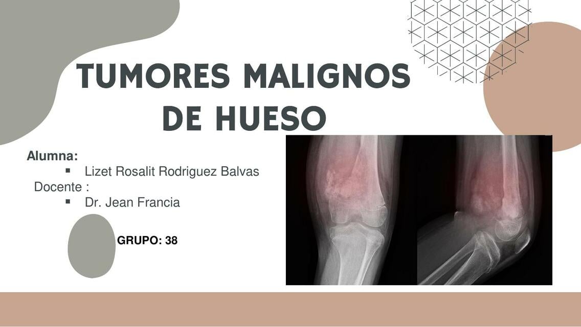 Cancer de hueso Lizet Rodriguez | Lizet Rodriguez Balvas | uDocz