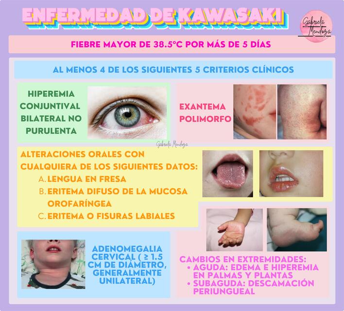 Enfermedad de Kawasaki | Gaby Mendoza | uDocz