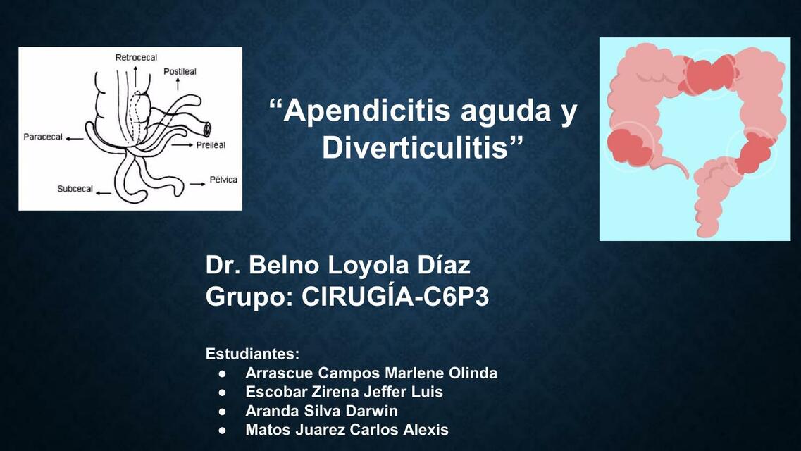 Apendicitis agua y diverticulitis | Marlene Olinda Arrascue campos | uDocz