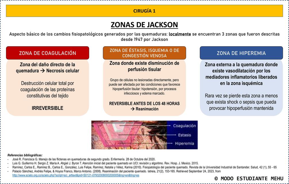 Zonas de Jackson - Quemadura | Modo Estudiante MEHU | uDocz