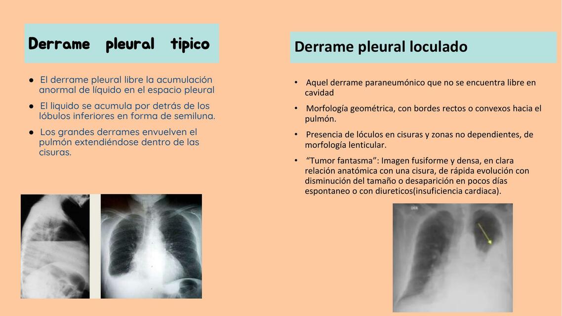 Derrame pleural | Lupita | uDocz