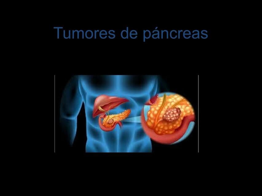 Tumores de Páncreas | Dra. F | uDocz