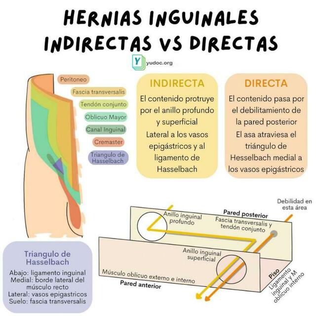 Hernias Inguinales | YUDOC.ORG | uDocz