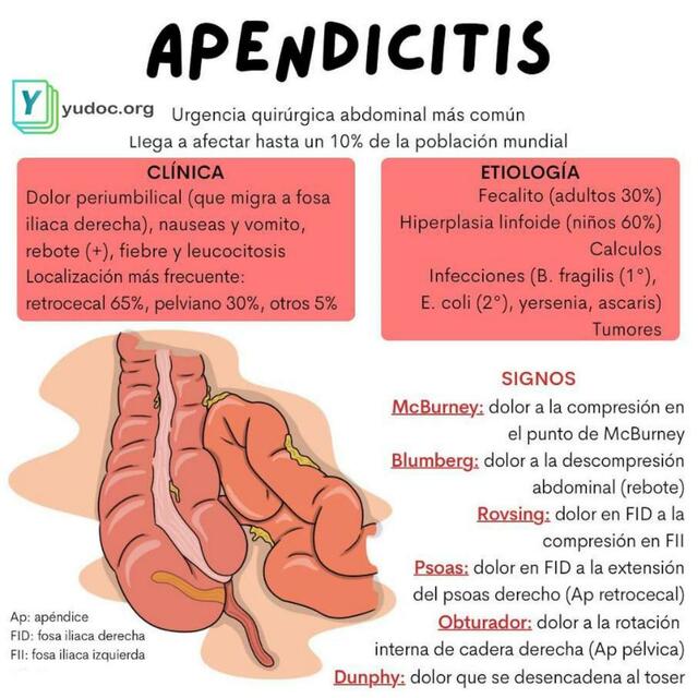 Apendicitis | YUDOC.ORG | uDocz