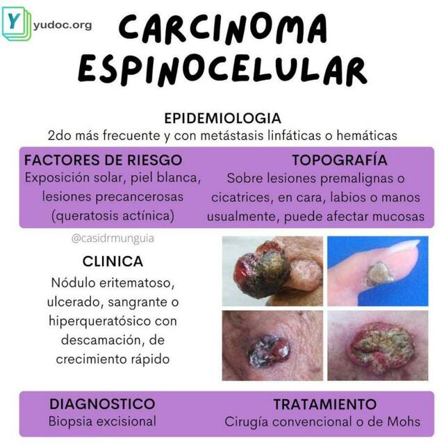 Carcinoma Espinocelular | YUDOC.ORG | uDocz