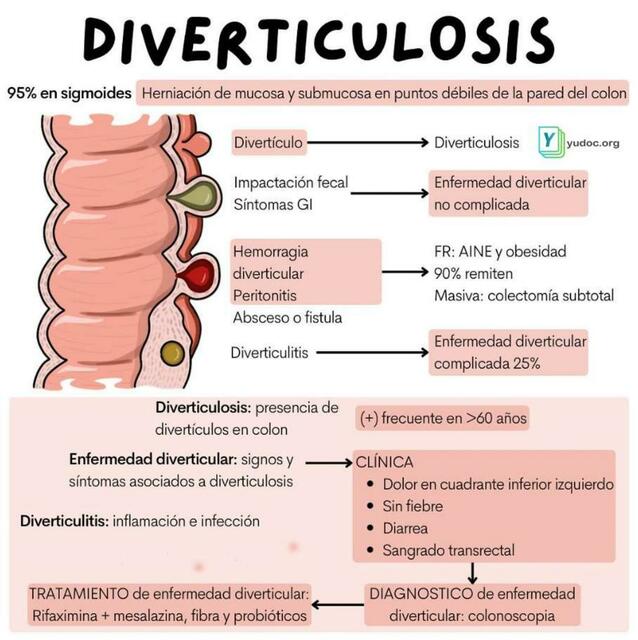 Diverticulosis | YUDOC.ORG | uDocz