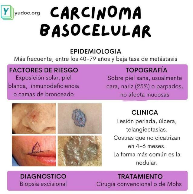 Carcinoma Basocelular | YUDOC.ORG | uDocz