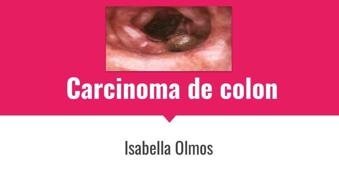 Carcinoma de colon | Isabella Olmos | uDocz