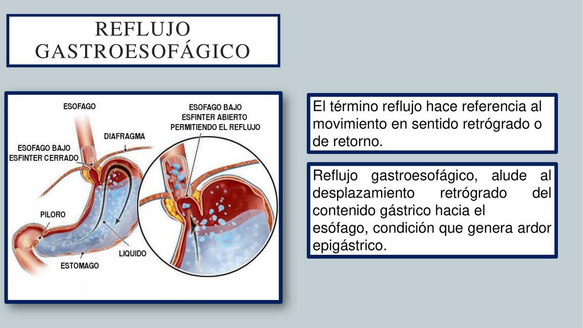 Reflujo Gastroesofágico | Doctorada11 | uDocz