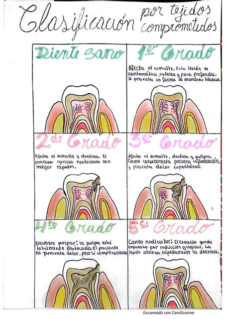 Clasificación Caries de Black por tejido comprometidos | Dentalgama ...