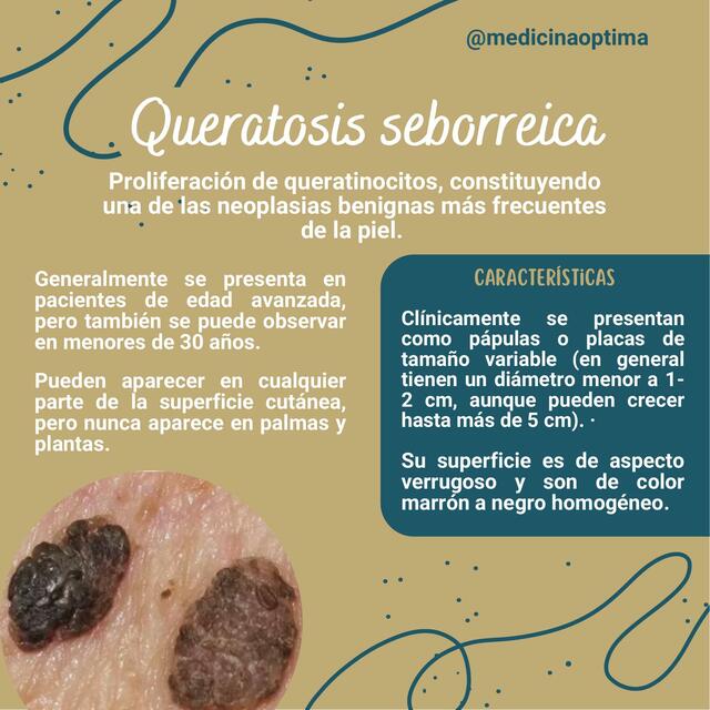 Queratosis seborreica | Medicina Óptima | uDocz