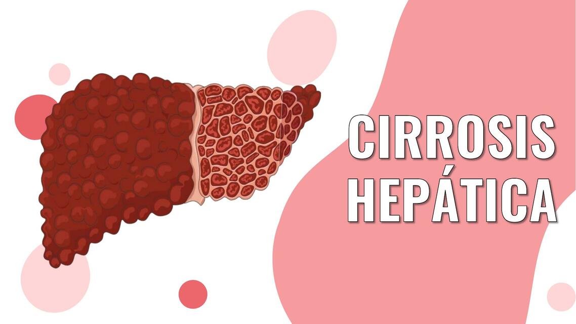 Cirrosis Hepática | Josselin Choquehuanca Muñoz | uDocz