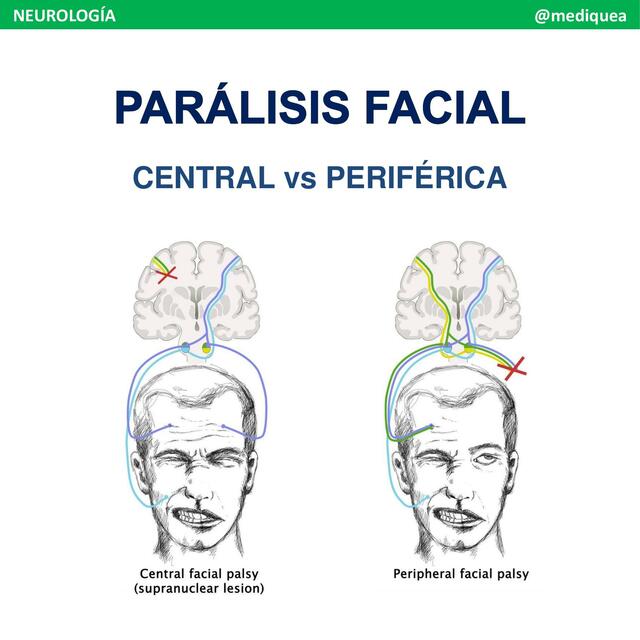 Paralisis facial central vs periferica | Ariel | uDocz