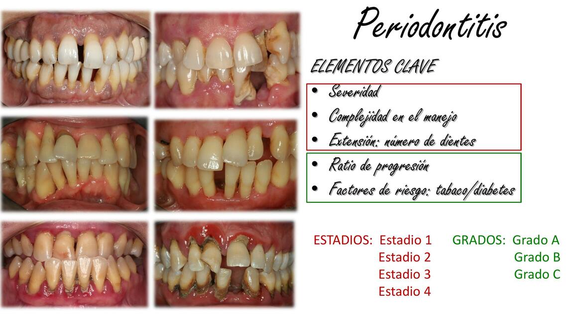 Periodontitis y sus Estadios | Odalys Del Valle Pino de Moreno | uDocz