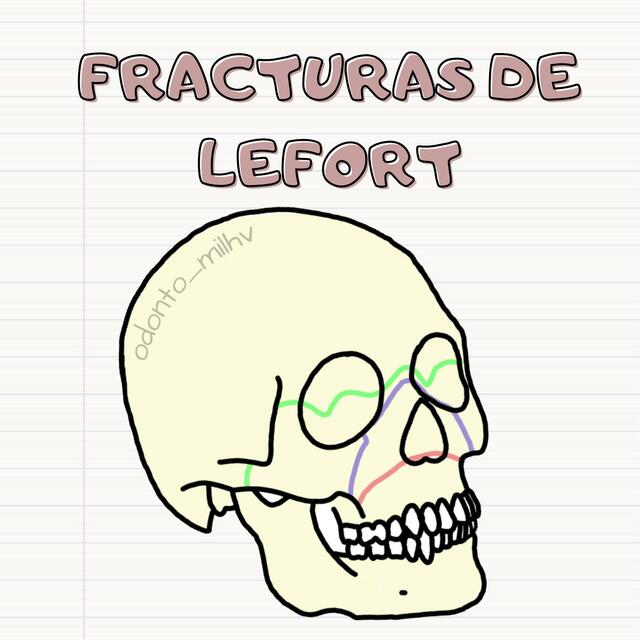 Fracturas de Lefort | Milena Bustos | uDocz