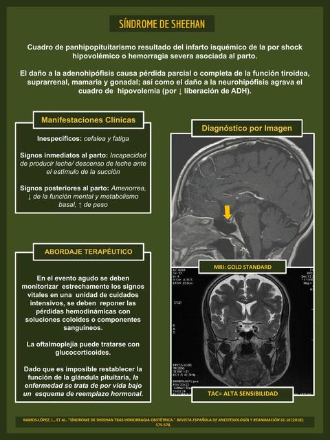 Sindrome de Sheehan | Ivan Salas Gaeta | uDocz
