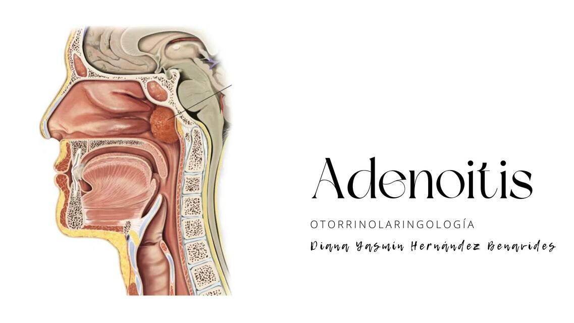 Flashcards de Adenoitis | Por Diana Hernández | uDocz