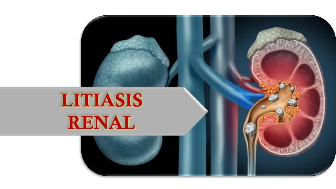 UROLITIASIS | 𝑲𝒂𝒇𝒆𝒔𝒉𝒊𝒕𝒐02 | uDocz