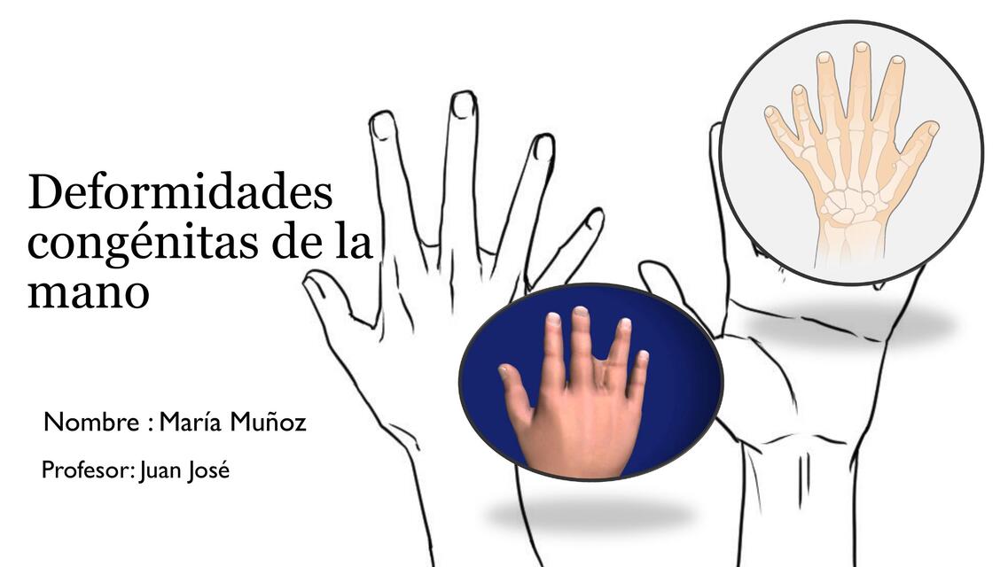 Deformidades congénitas de la mano | maria irene muñoz sanchez | uDocz
