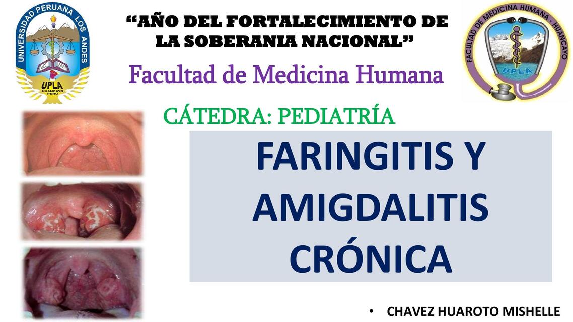 Amigdalitis y faringitis crónica | Mishelle Chavez | uDocz
