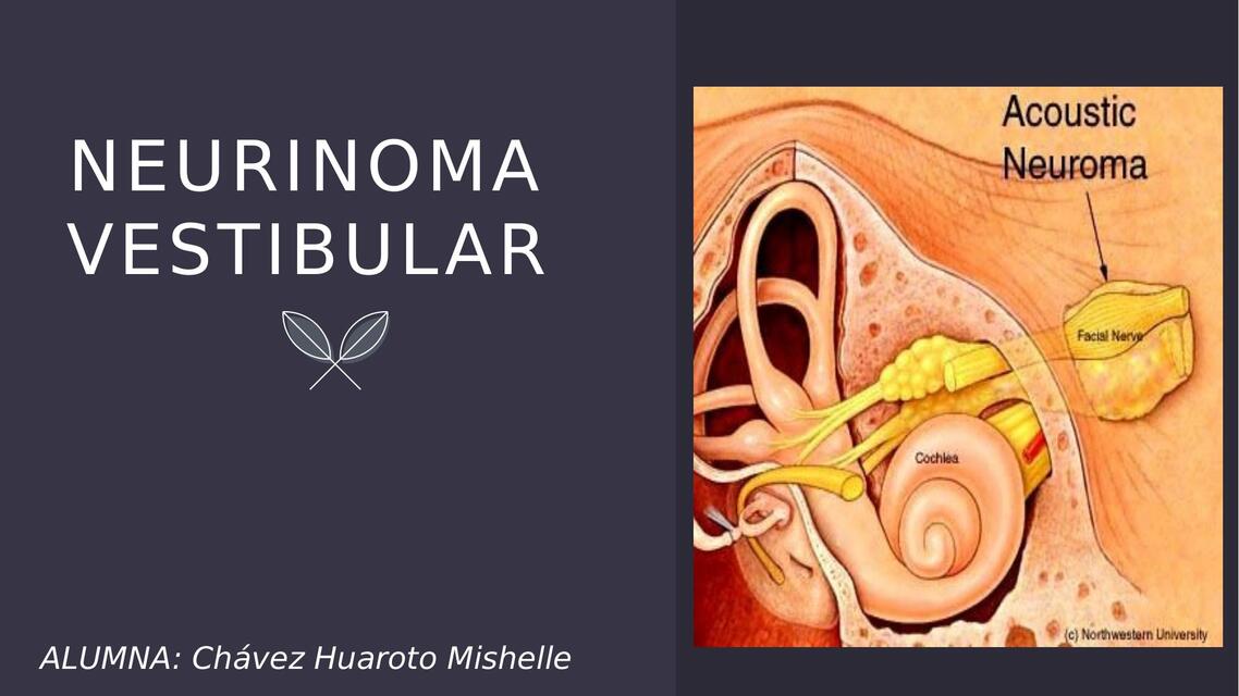 Neurinoma Vestibular | Mishelle Chavez | uDocz