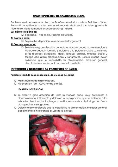 Caso Hipotético de Candidiasis Bucal | paola alzamora | uDocz