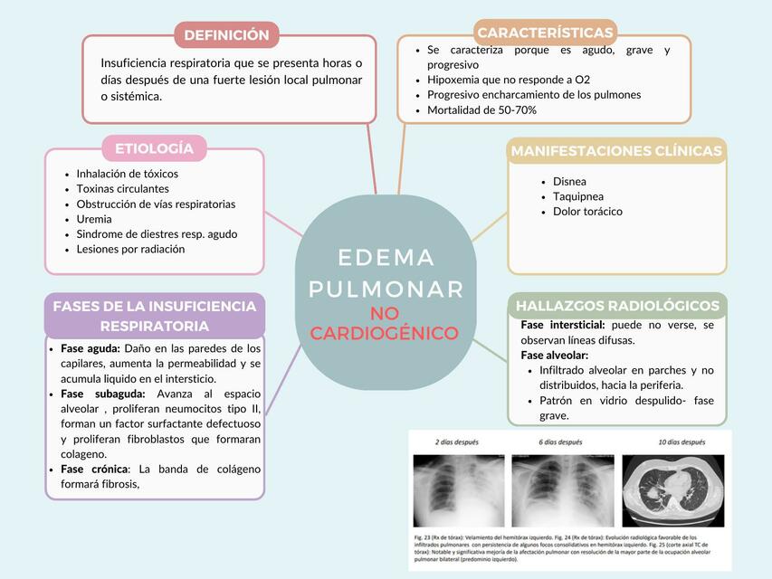 Diagrama De Edema Pulmonar Fluidoterapia En Distrés Respiratorio: