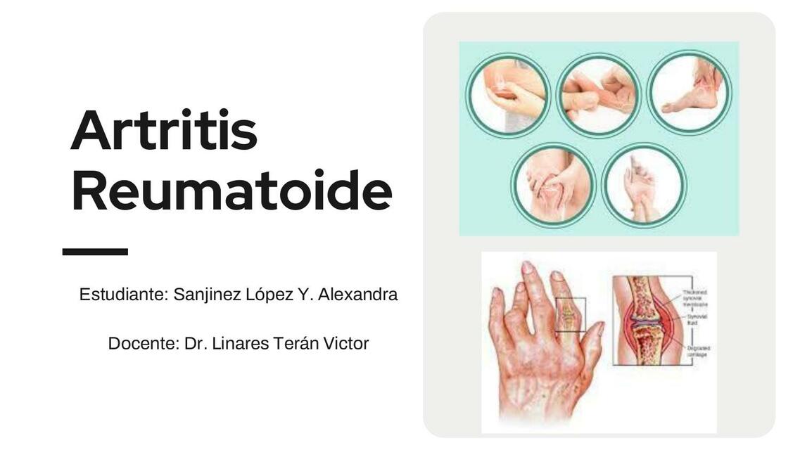 Artritis Reumatoide | Isrrael Vargas | uDocz