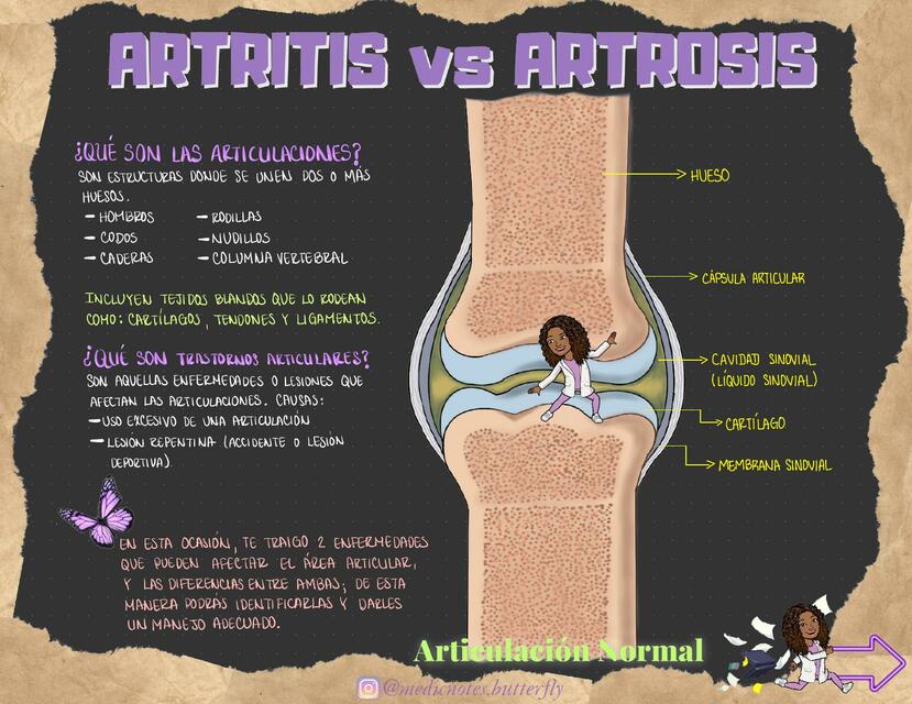 Artritis Vs Artrosis | LISBETH ASPRILLA | uDocz